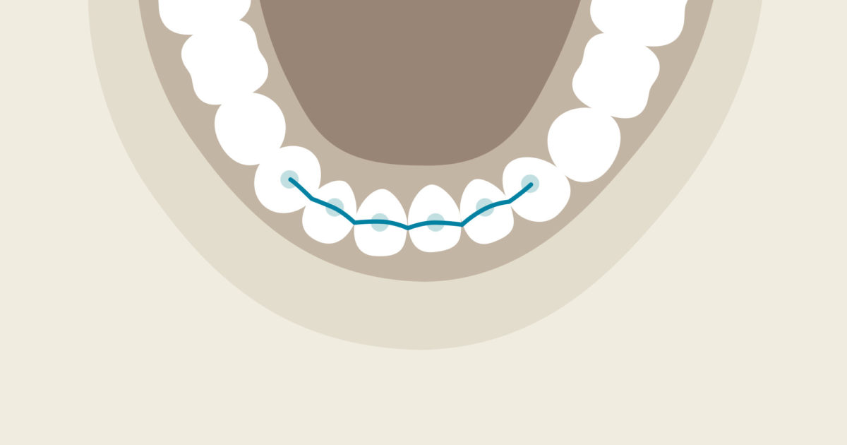 Retention & Retainer · Kieferorthopäde Münster Wolbeck